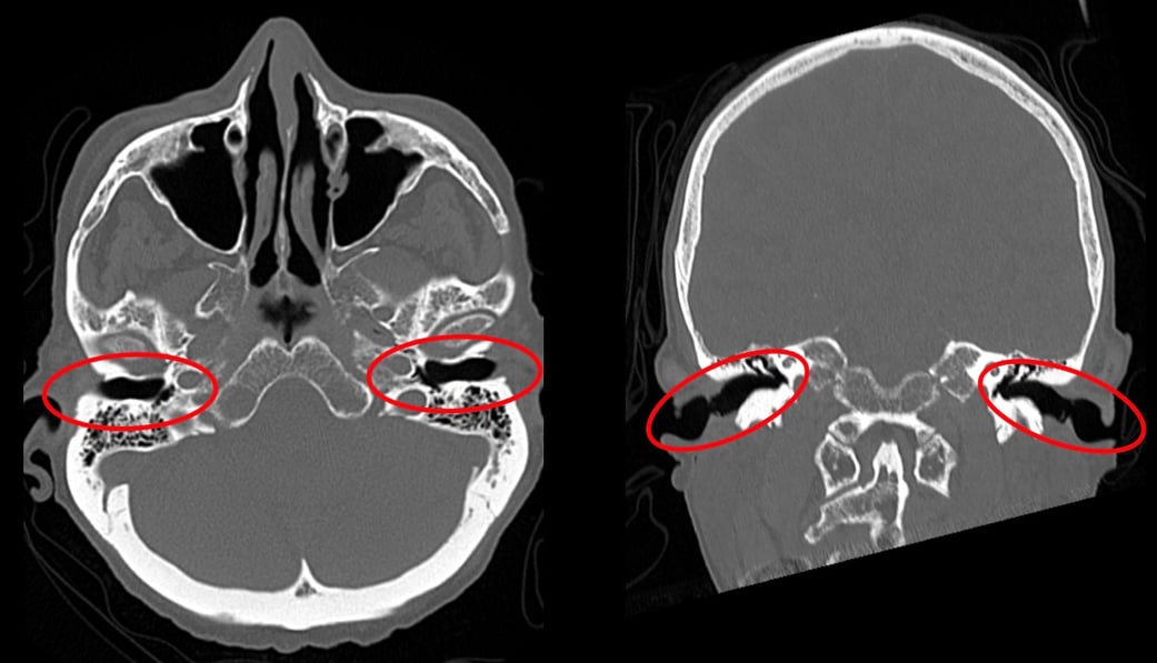 Head CT in lateral position, what if the standard can't be followed?