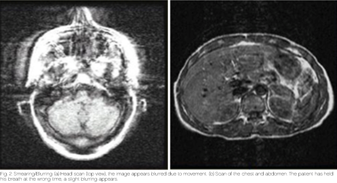 Motion artifacts in radiology: