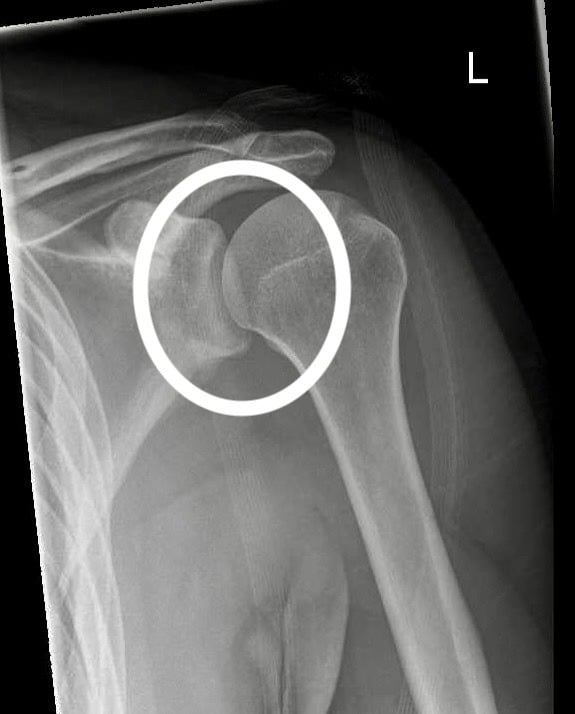 Shoulder X-ray - One joint, many possibilities
