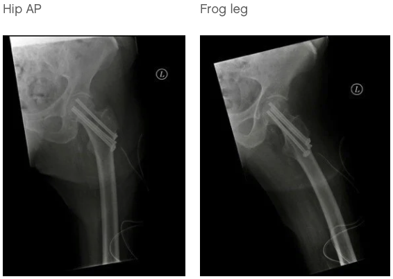 ONCE FROG LEG, ALWAYS FROG LEG?